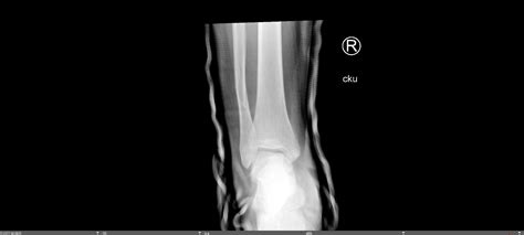 Trimalleolar Ankle Fracture — Chicago Foot And Ankle Orthopaedic Surgeons