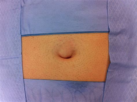 Herniated Belly Button Surgery