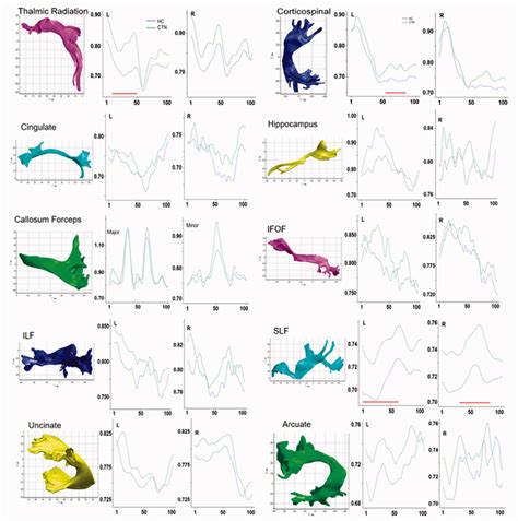 The Md Analysis Of 100 Nodes Of 20 Nerve Fiber Tracts In Ctn Patients