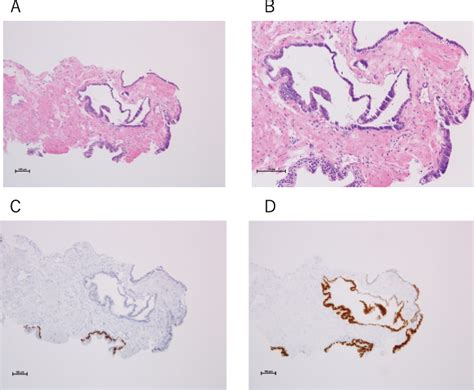 Case Report A Case Of Macrocystic Ductal Adenocarcinoma Of The