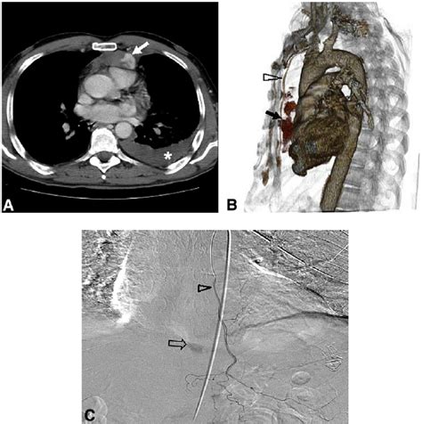 Computed Tomography Scan Of The Chest A Sagittal Three Dimensional Download Scientific