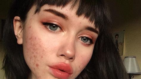 Acne Mark Elimination Treatments My Fitness Clubb