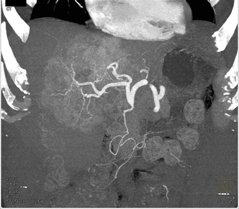 Intrahepatic Cholangiocarcinoma Liver Case Studies Ctisus Ct Scanning