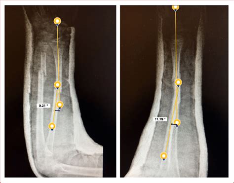 Measurement Of Radial Fracture Angulation In Ap And Lateral Radiographs