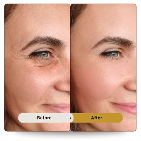 Full Face Botox Injection And Treatments In Dubai