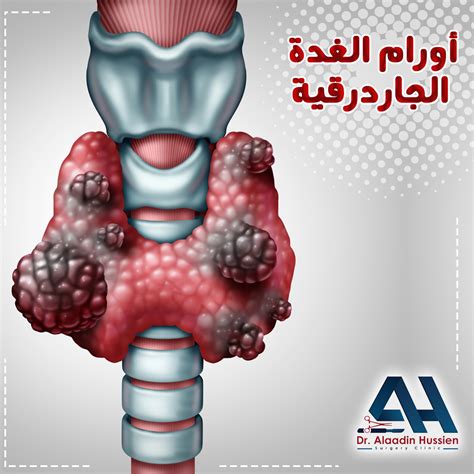 أورام الغدة الجاردرقية Dralaadin