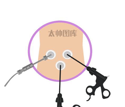腔镜手术 医学插画