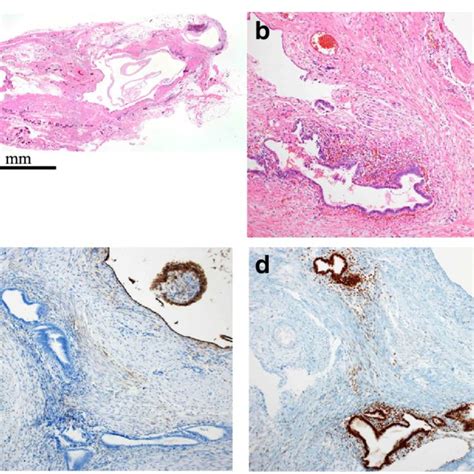 Histological Examination Of The Excised Cyst A The Cyst Was Tortuous