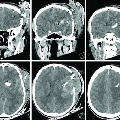Preoperative Ct Of The Head Demonstrating The Extent Of Scalp