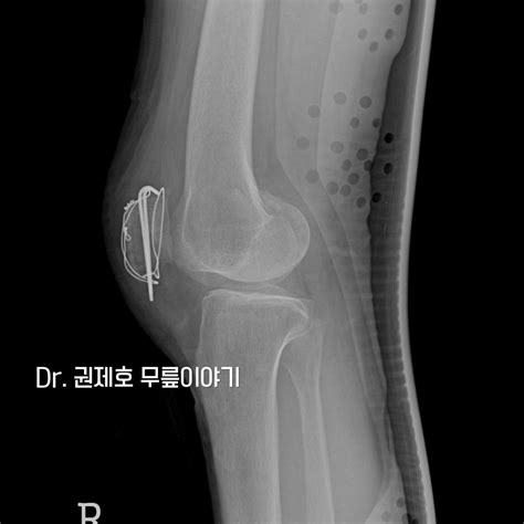 무릎슬개골골절 와이어를 이용한 8자 고정술 네이버 블로그