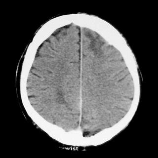 A Case Of Convexity SE Non Contrast CT Of The Brain Demonstrating Download Scientific Diagram