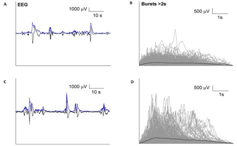 3 Comparisons Of Eeg Bursts In Normal Preterm And Ivh Preterms A