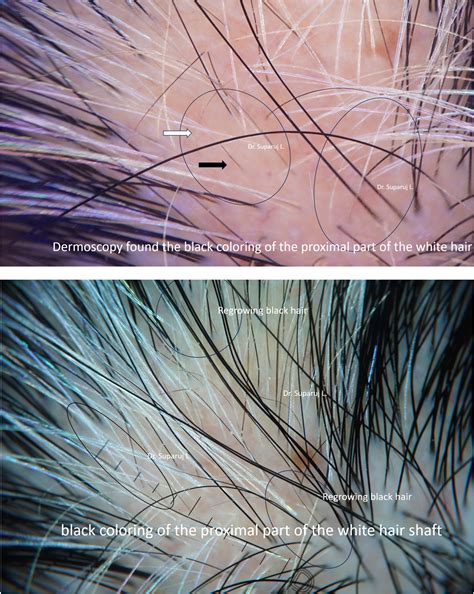 Hair Repigmentation Of Poliosis Circumscripta In Androgenetic Alopecia