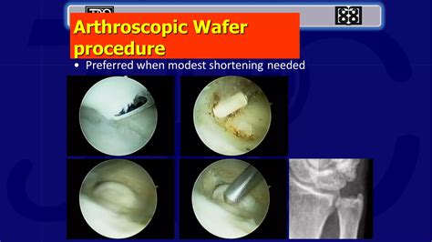 Tfcc Triangular Fibro Cartilage Complex Injury Ppt