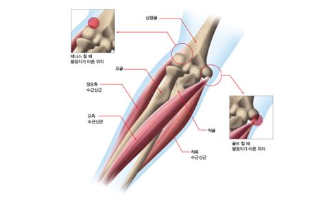 전통이 살아있는 팔꿈치보호대 맥데이비드 Mcdavid 네이버 블로그