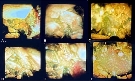 Percutaneous Cholangioscopy Utilizing Spyglass Discover For Difficult