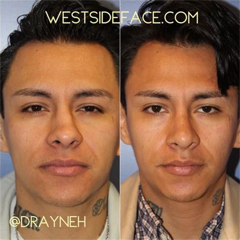 Crooked Nose Repair Westside Face
