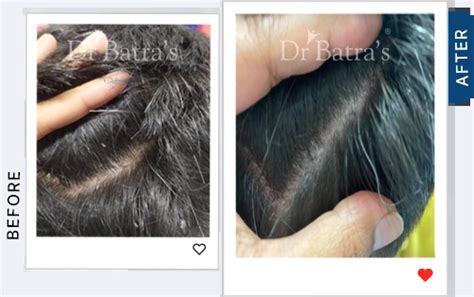 Types Of Dandruff Causes Symptoms Solutions Dr Batra S