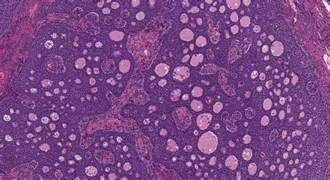 Adult Type Granulosa Cell Tumour Ottawa Atlas Of Pathology