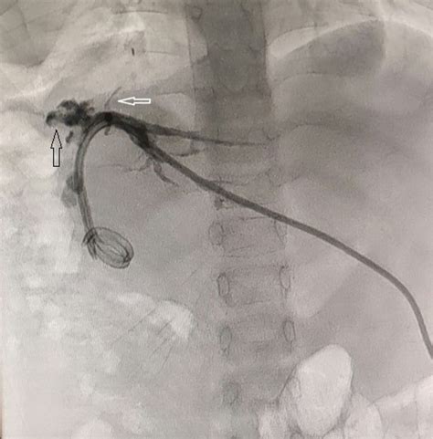 Image Of The Percutaneous Transhepatic Cholangiography Demonstrating
