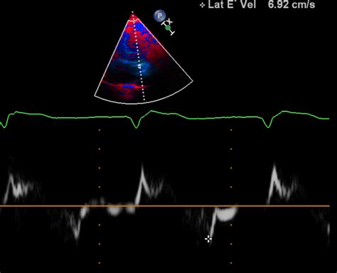 What Does Lvidd Mean On An Echocardiogram