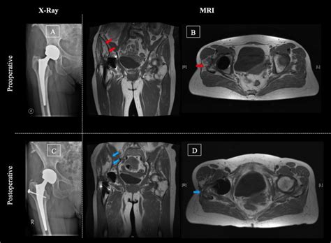 Recovery Of Muscular Tissue And Functional Results Of Patients Treated With A Gluteus Maximus