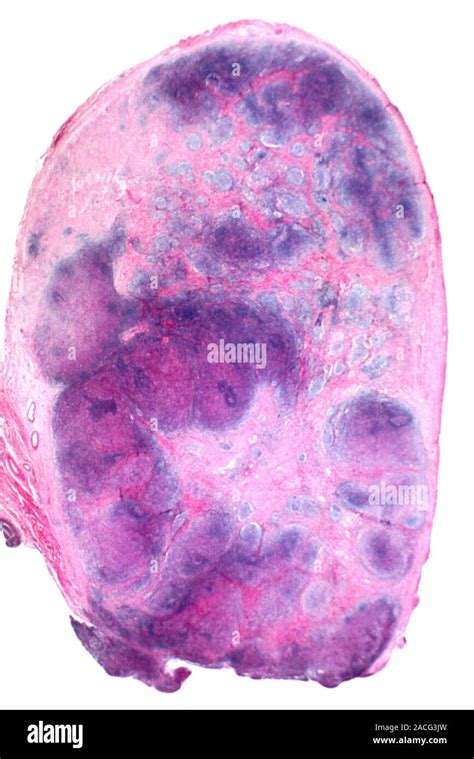 Hodgkins Disease Light Micrograph Of A Section Through A Lymph Node