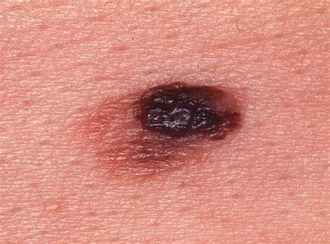 Genetic Tests Show How Sunlight Turns Moles Into Melanoma