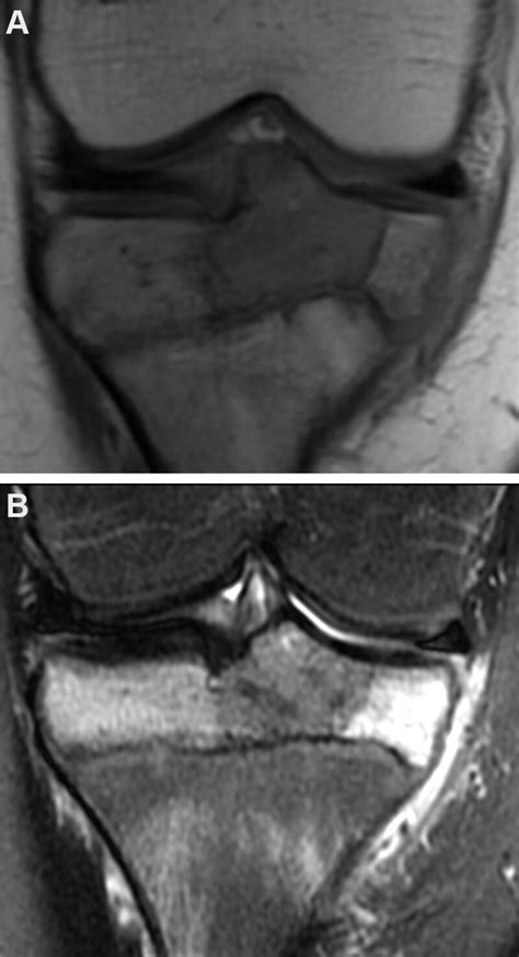Epiphyseal Bone Lesions Radiology