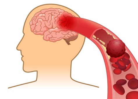 Sudden Temporary Blurry Vision When To See Doctor Scary Symptoms