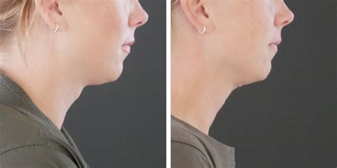 Do Women Have Adams Apples