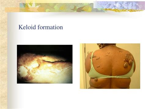 Ppt Integumentary Burns Powerpoint Presentation Id 337965