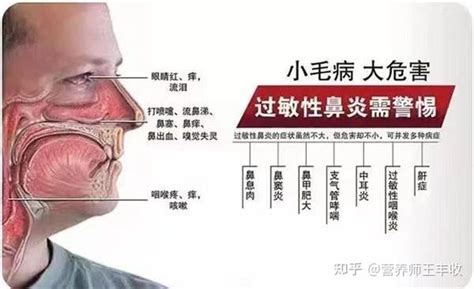 孩子查出腺样体肥大75，医生说不用管，家长就不管了吗？ 知乎