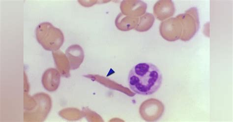 Fda Approves First Gene Therapies To Treat Patients With Sickle Cell