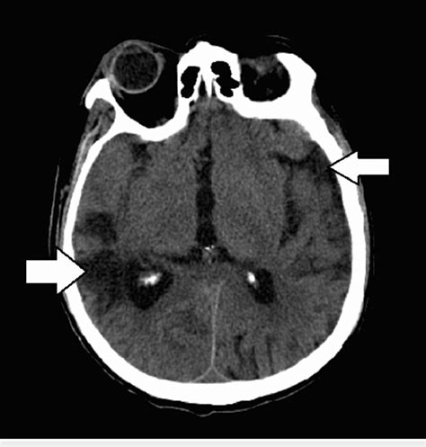 Ct Scan Of The Head Without Contrast Showing Diffuse Encephalomalacia