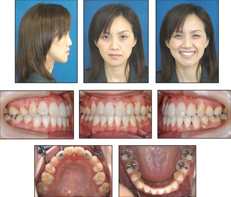 Class Iii Malocclusion With Complex Problems Of Lateral Open Bite And
