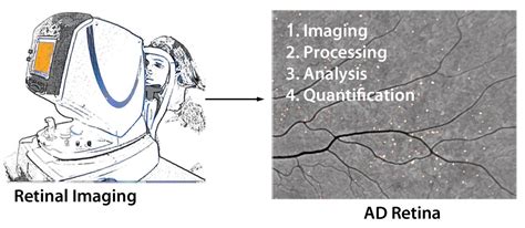 Presumed Amyloid Plaques Image Eurekalert Science News Releases