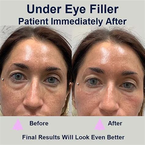 Theory Eye Rejuv™ Under Eye Filler Treatment Skin Theory Aesthetics