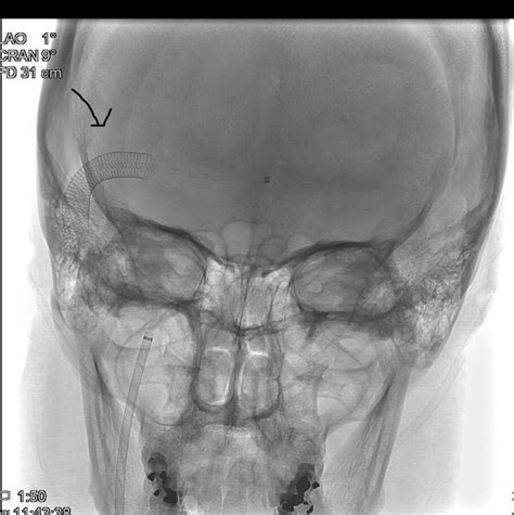 Awake Brain Surgery And A Stent My Journey To Healing And Resilience