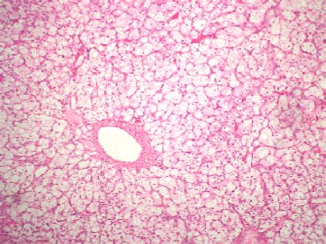 The Postoperative Paraffin Block Section Of Case 1 Download