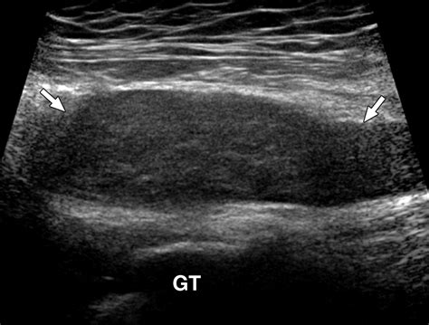 Musculoskeletal Ultrasound An Essential Tool In Diagnosing