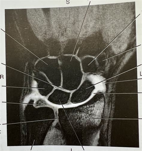 Coronal T1 Wrist Post Arthrogram Diagram Quizlet