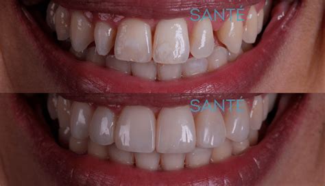 Facetas De Resina Em Dentes Conóides E Diastemas
