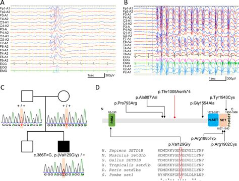 Eeg Findings And The Setd1b Variant In The Patient A Interictal Eeg Download Scientific