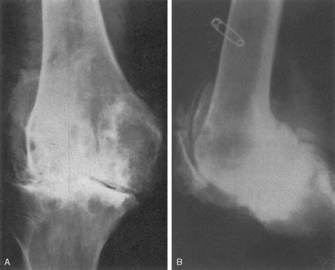 Calcium Pyrophosphate Dihydrate Crystal Deposition Disease Clinical Tree