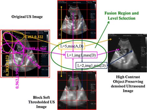 Fusion Algorithm For Developing Denoised High Contrast Ultrasound