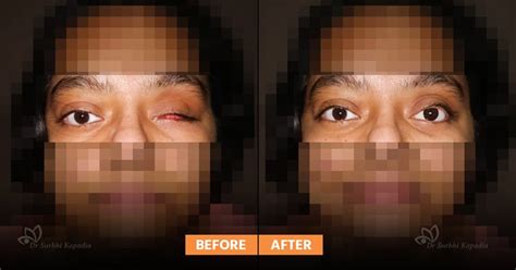 Qanda With Dr Surbhi Kapadia On Ptosis Surgery Recovery