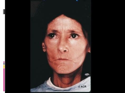 Scleroderma
