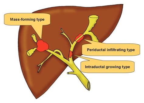 Varying Appearances Of Cholangiocarcinoma Radiologic Pathologic Correlation Radiographics