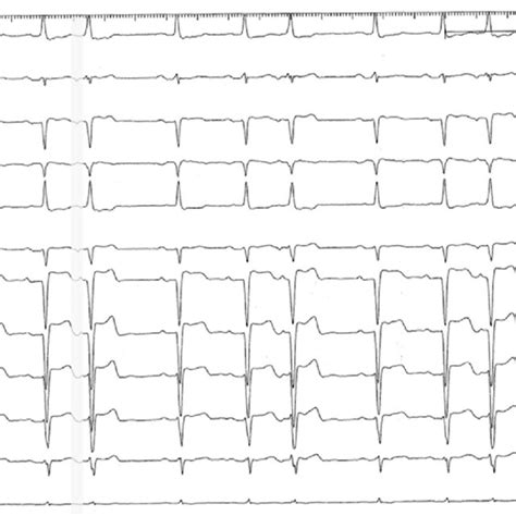Twelve Lead Ecg Showing Frequent Atrial Premature Beats P Wave Was